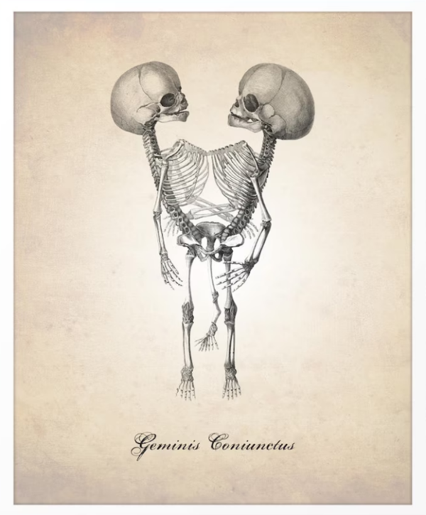 Conjoined Twins Anatomy Art Print (8"x10") - Captivating Science